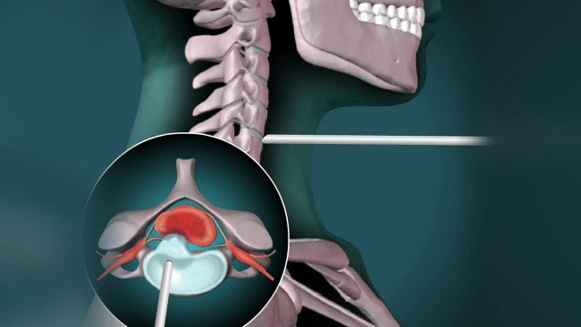 Endoscopic Anterior Cervical Discectomy | Minimally Invasive Spine Surgery