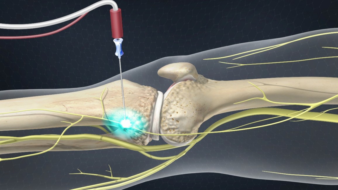 Genicular Nerve Ablation - maywell health