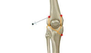 Genicular Nerve Block - maywell health